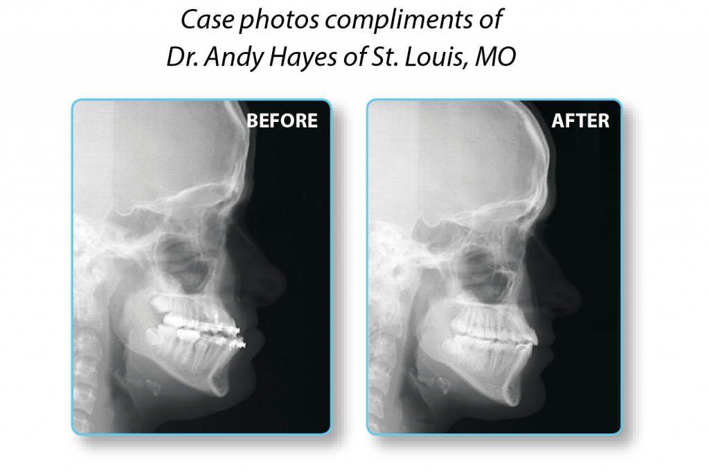CS System Class II and Class III Corrector - DynaFlex