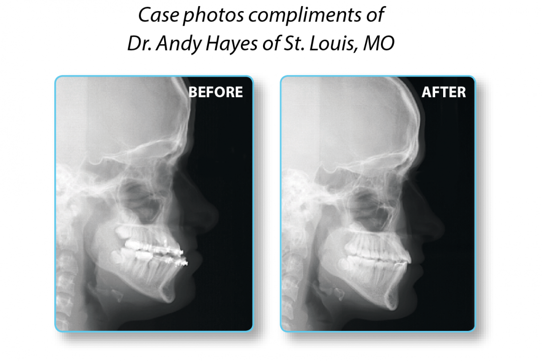 CS System Class II and Class III Corrector - DynaFlex