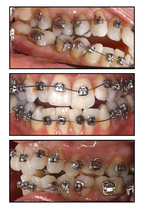 The Norris System - DynaFlex