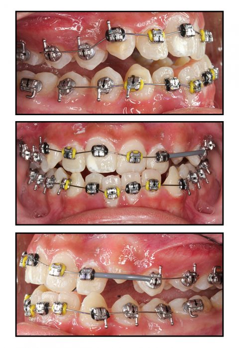 The Norris System - DynaFlex