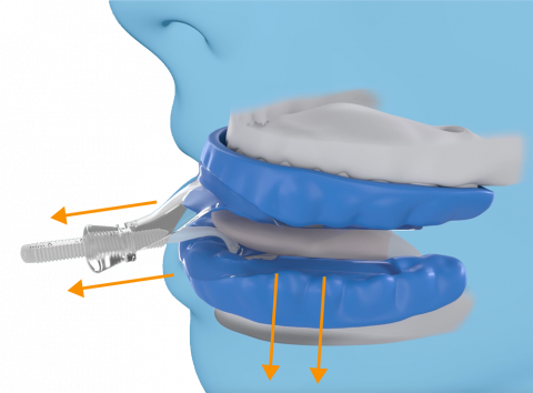 Tap® Devices - DynaFlex