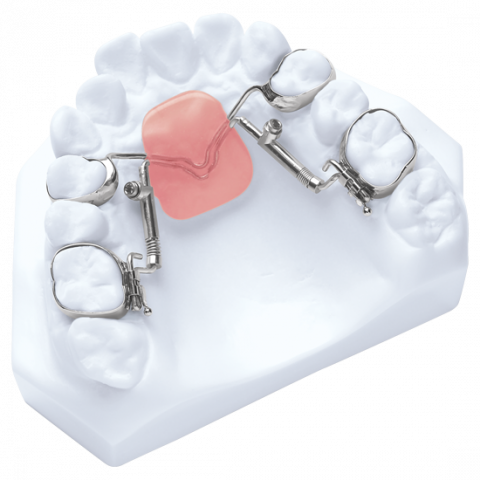 Distalizers - DynaFlex