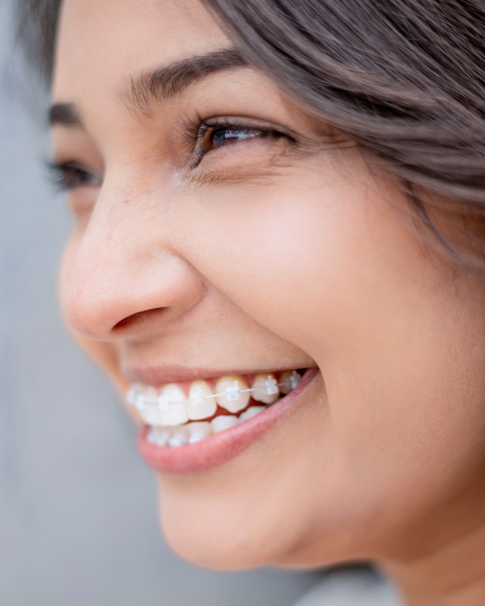 Norris 20/26 Clear Brackets - DynaFlex